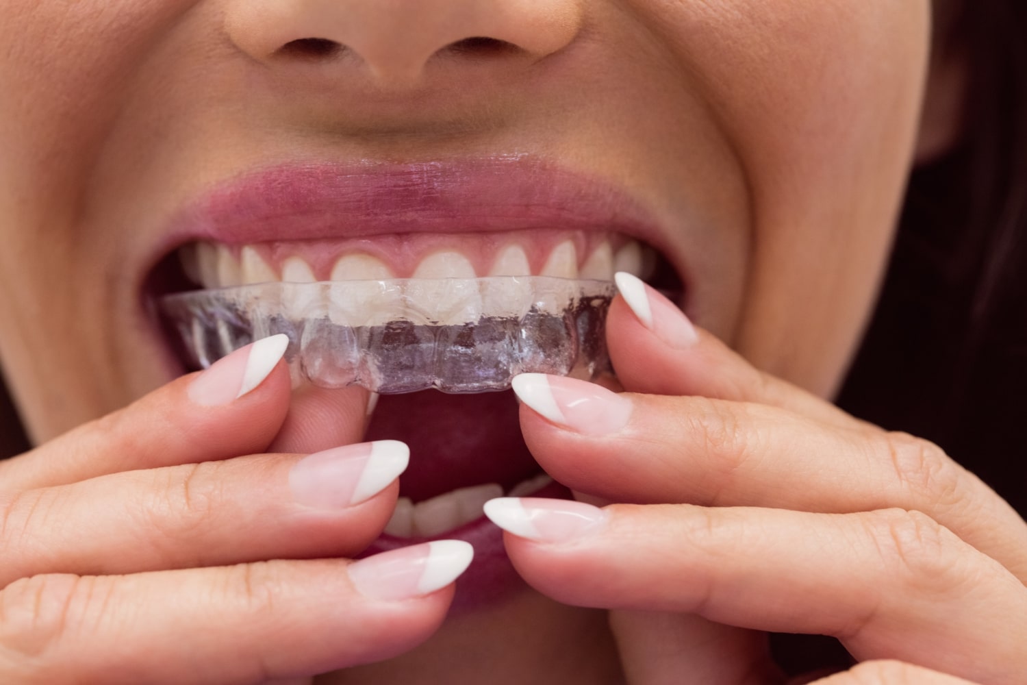 Braces and the different methods of orthodontic treatments