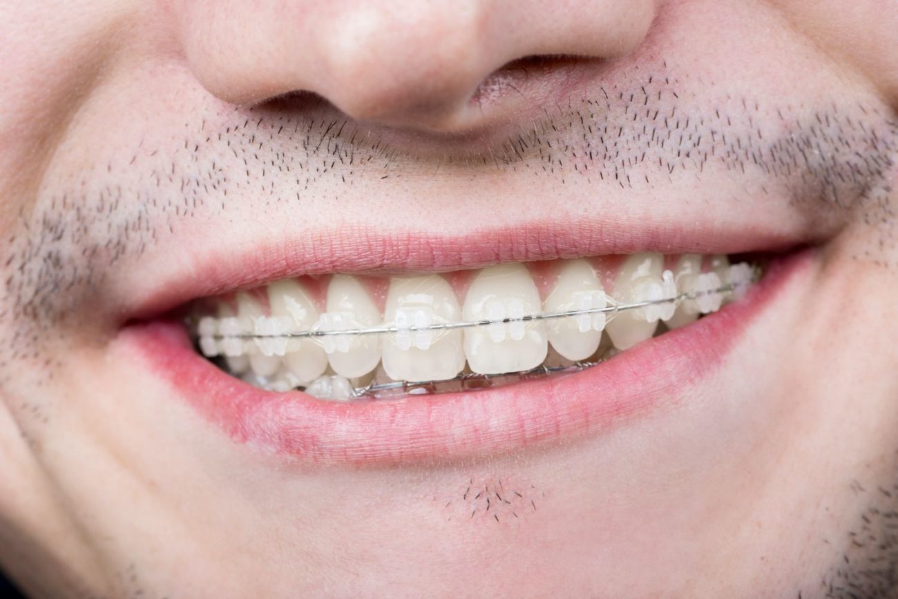 Braces and the different methods of orthodontic treatments