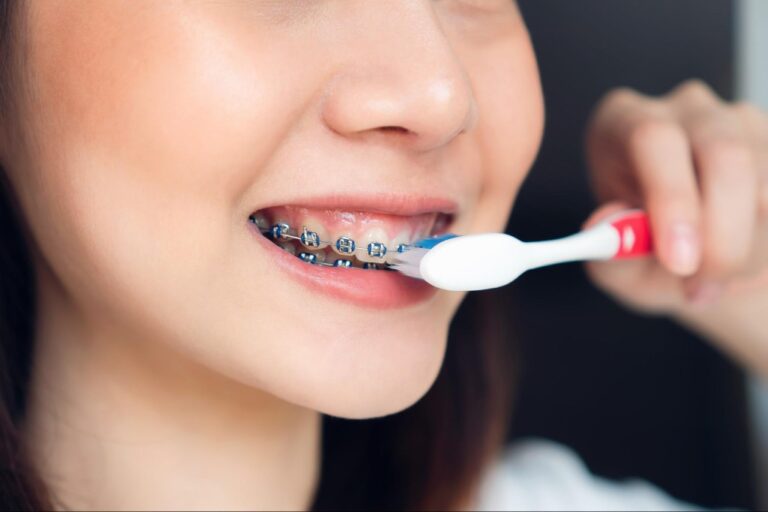 Tips for Brushing Your Teeth with Braces – Somos Dental