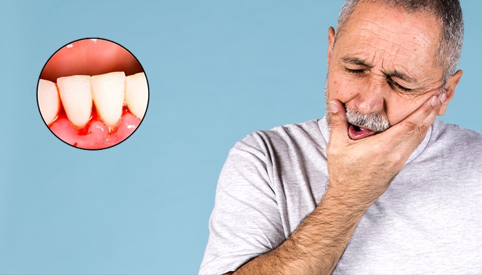 Why do I have bleeding gums? Causes-and-treatment