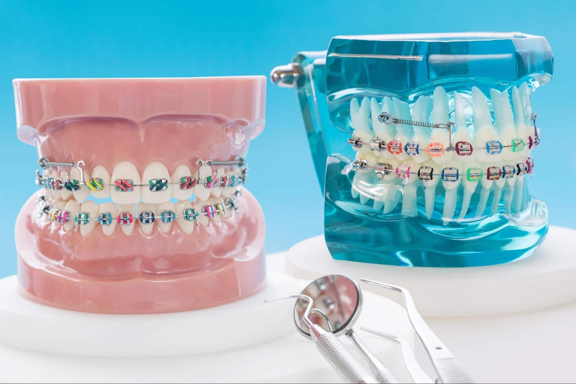 Estilo en tu Sonrisa: Ideas de Colores para Brackets