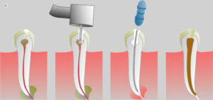 Endodoncia y Corona, diferencias y beneficios - Somos Dental
