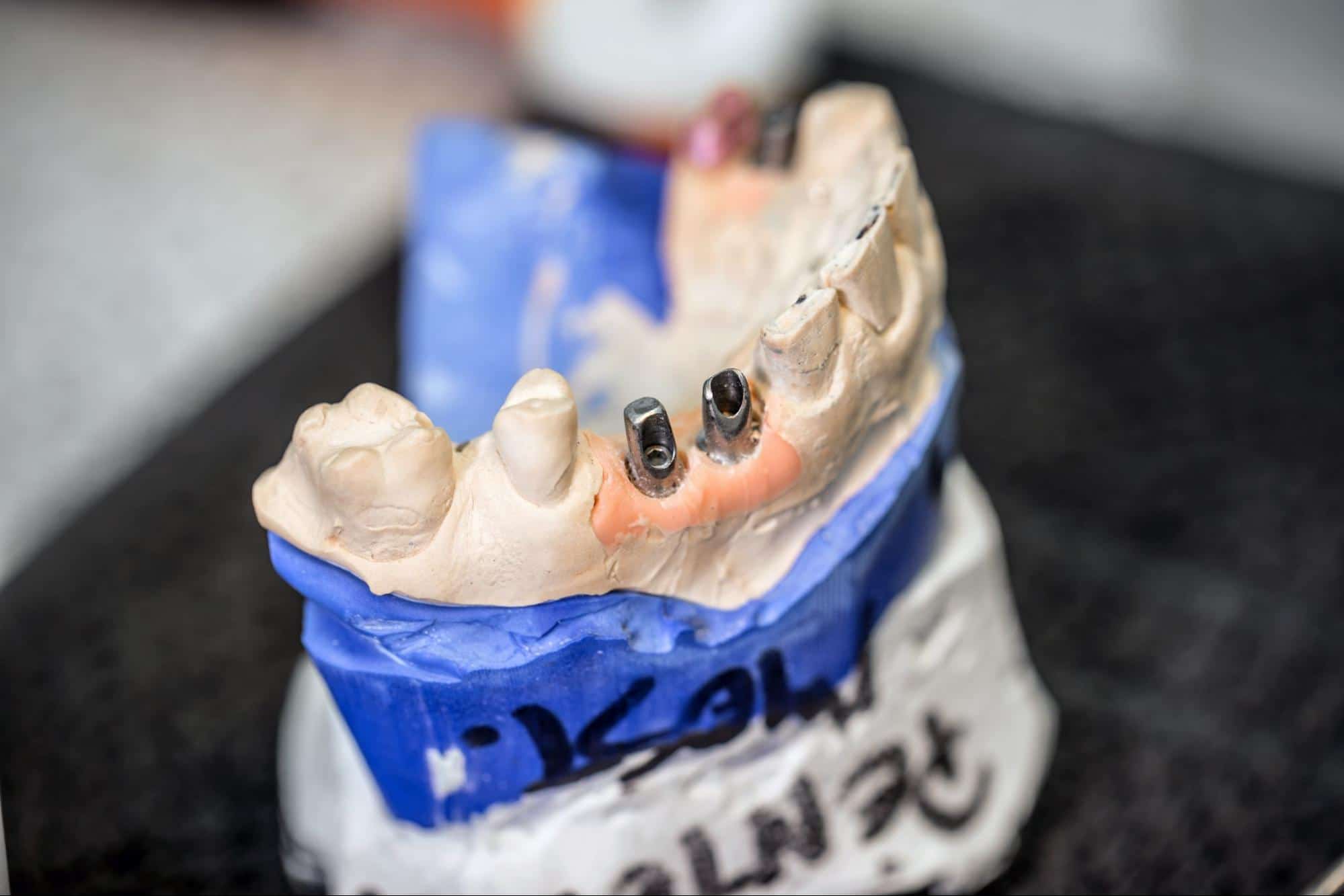 What is a dental implant healing cap? – Somos Dental