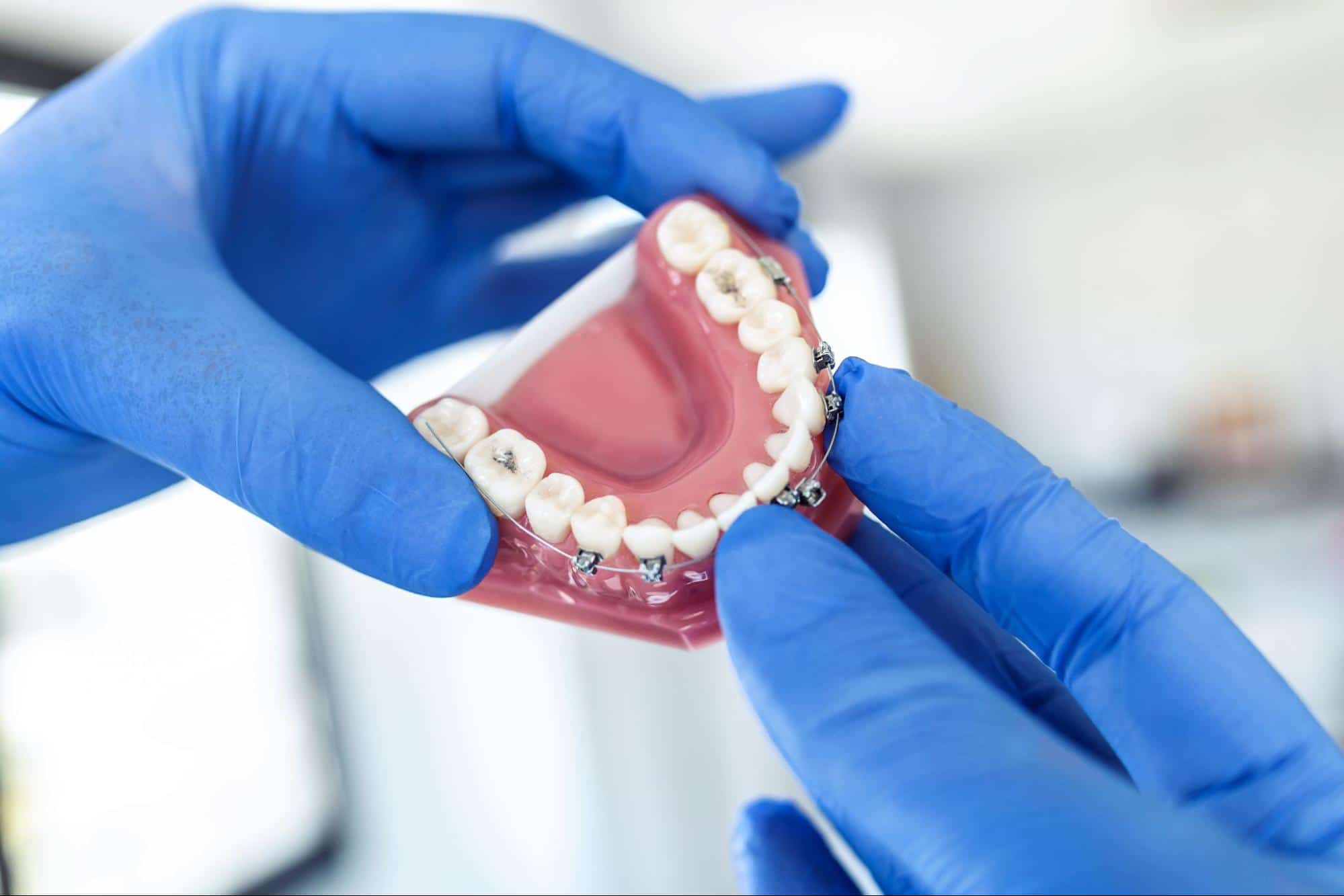 How are braces tightened? – Somos Dental