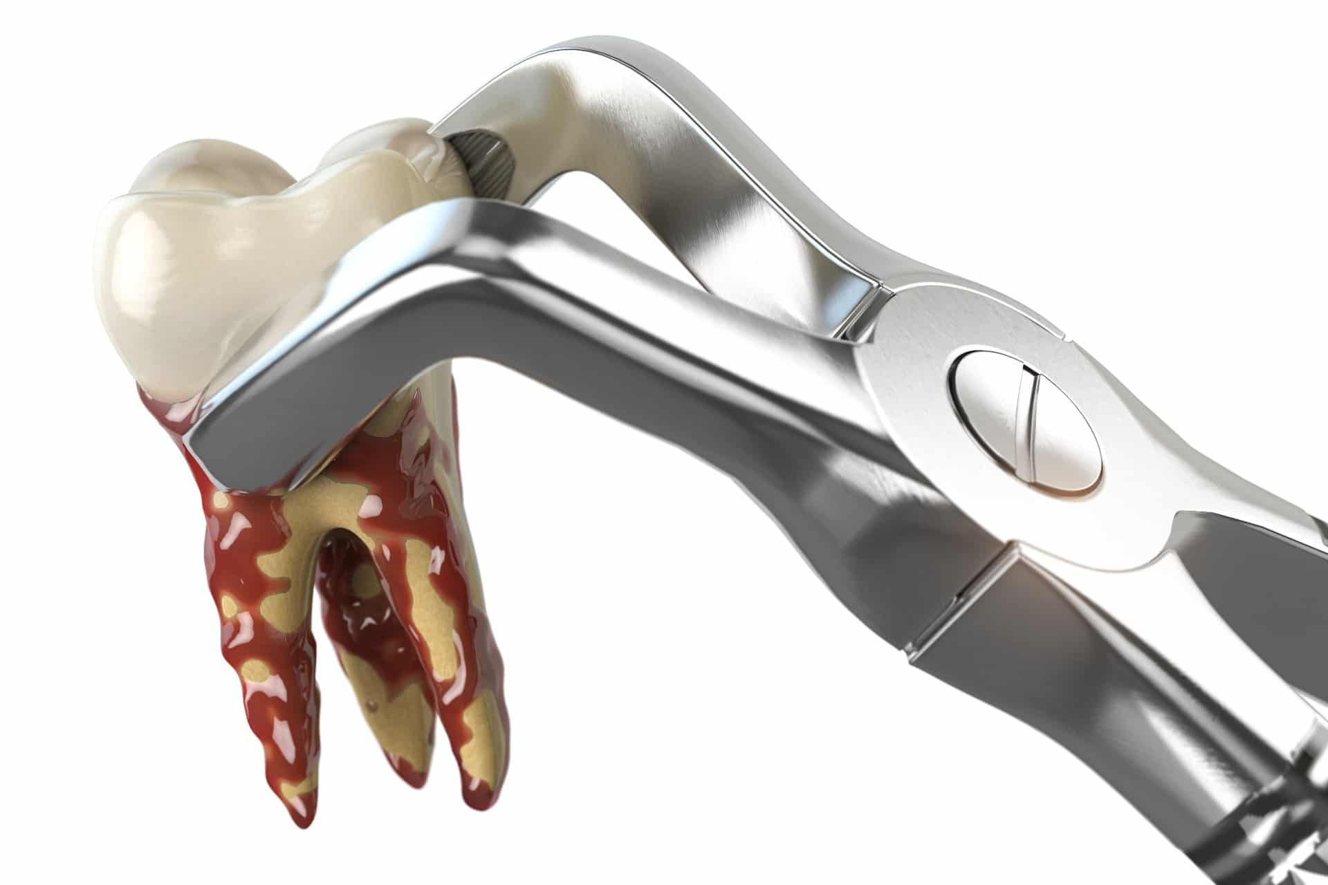 The Mystery of Impacted Wisdom Teeth
