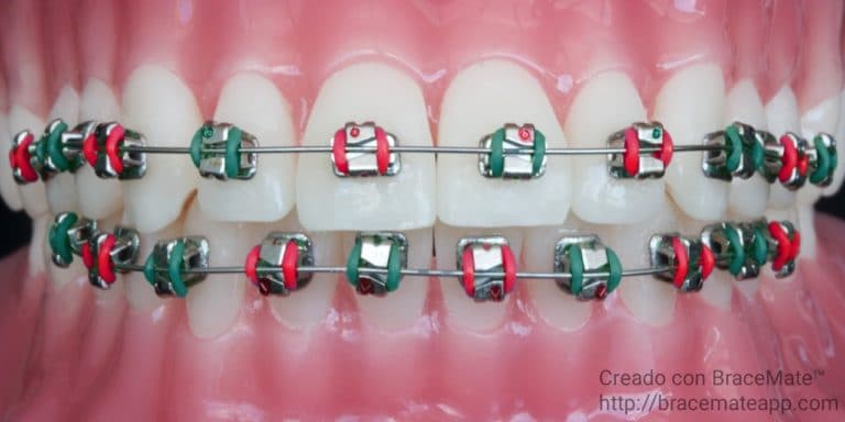 12 Ideas de Colores para Brackets para Destacar! – Somos Dental
