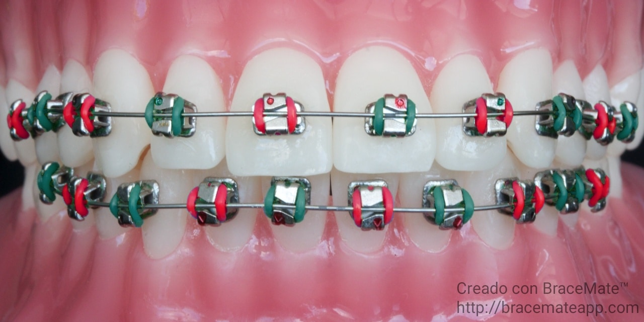 12 Ideas de Colores para Brackets para Destacar! – Somos Dental