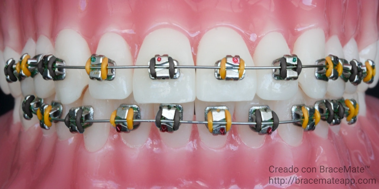 12 Braces Colors Ideas to Stand Out! – Somos Dental