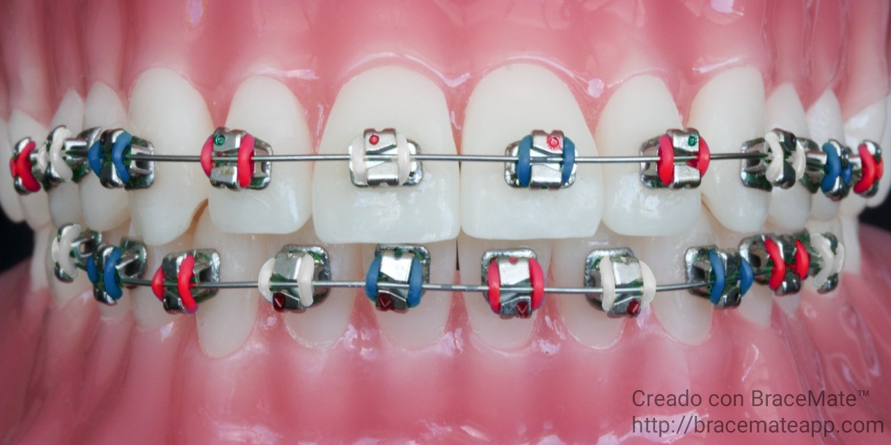 12 Braces Colors Ideas to Stand Out! – Somos Dental