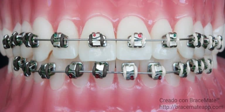 12 Ideas de Colores para Brackets para Destacar! – Somos Dental