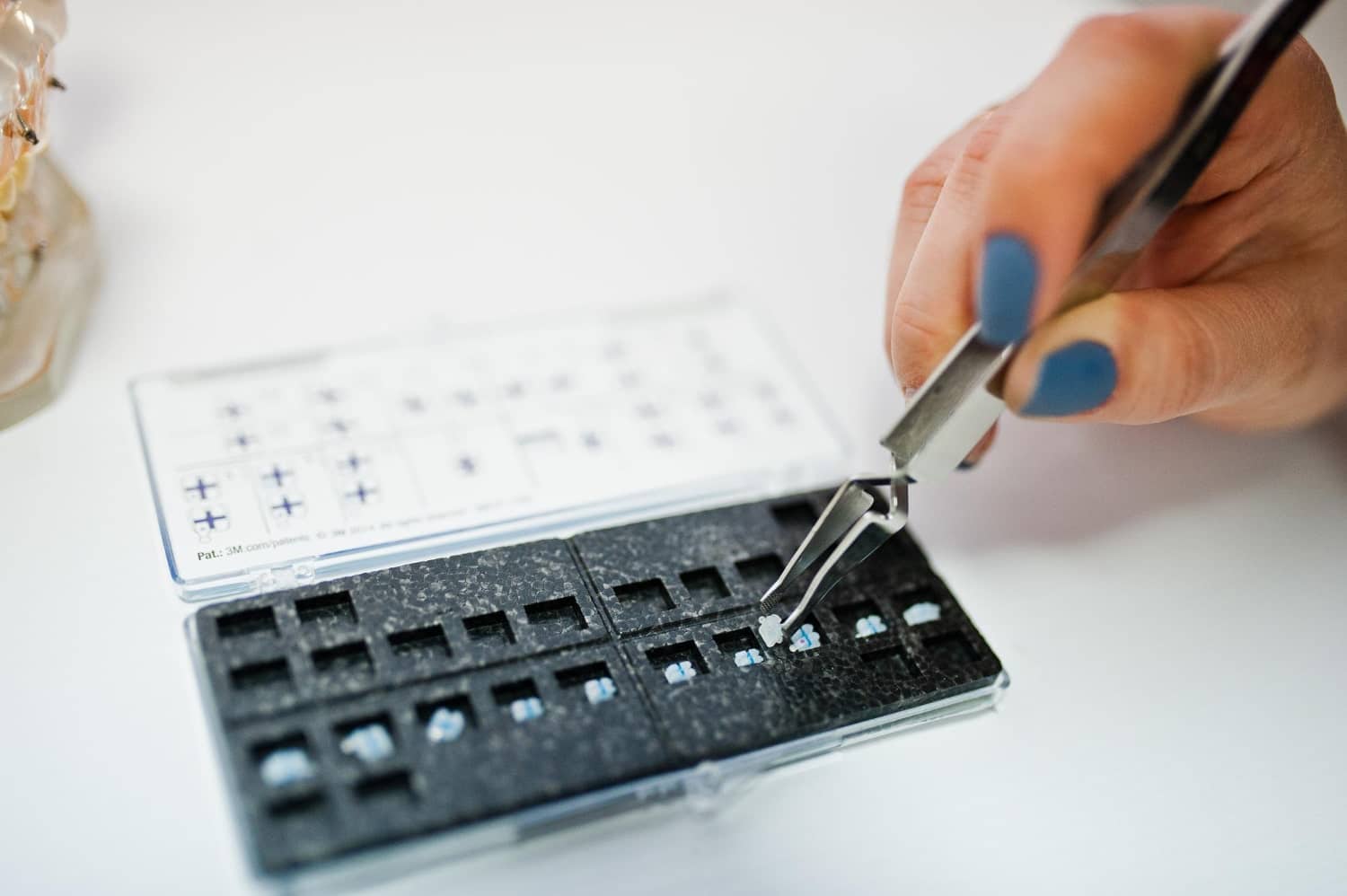 How long can you go with a loose bracket? – Somos Dental